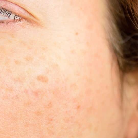 Skin Conditions We Treat - Viola Laser and Skin Care Clinic