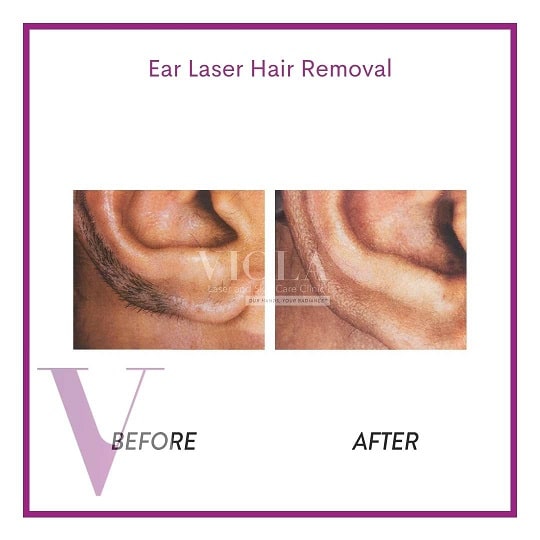 ProCell Therapies Micro-Channeling and Micro-Needling - Viola Laser and ...