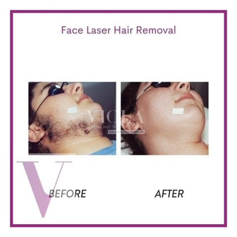 ProCell Therapies Micro-Channeling and Micro-Needling - Viola Laser and ...