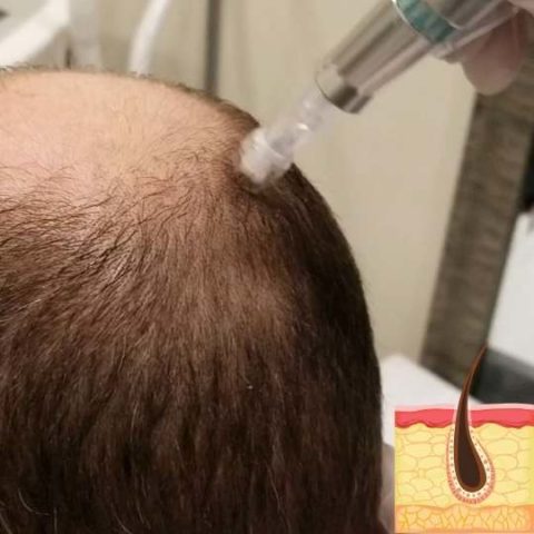 Microneedling Treatment for Hair Loss - Viola Laser and Skin Care Clinic