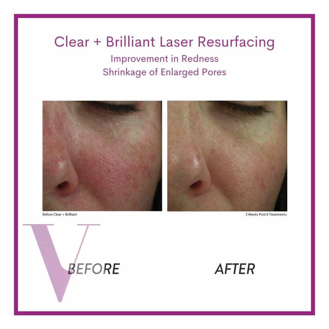 Clear and Brilliant Resurfacing Laser - Viola Laser and Skin Care Clinic