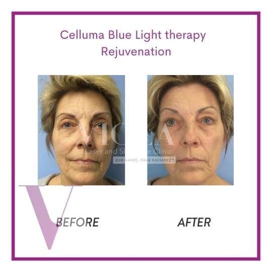 LED Light Therapy - Celluma - Viola Laser and Skin Care Clinic