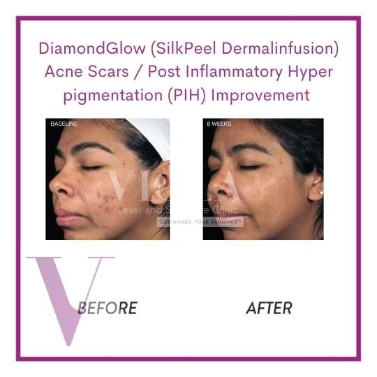 DiamondGlow SilkPeel Dermalinfusion Facial - Viola Laser and Skin Care ...
