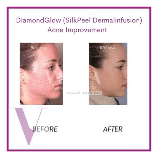 DiamondGlow SilkPeel Dermalinfusion Facial - Viola Laser and Skin Care ...