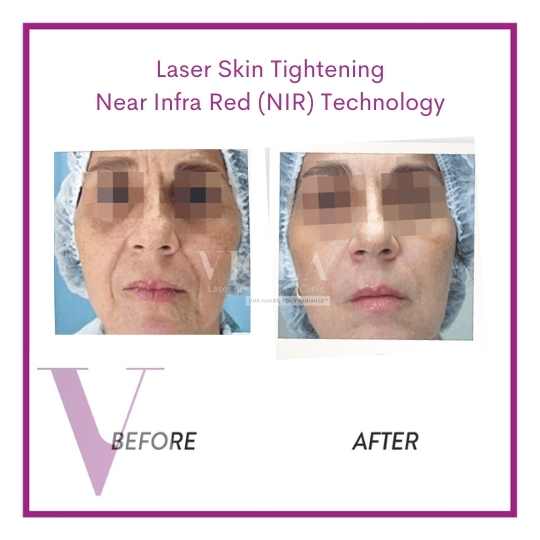 Alma Near Infrared (NIR) Skin Tightening - Viola Laser and Skin Care Clinic