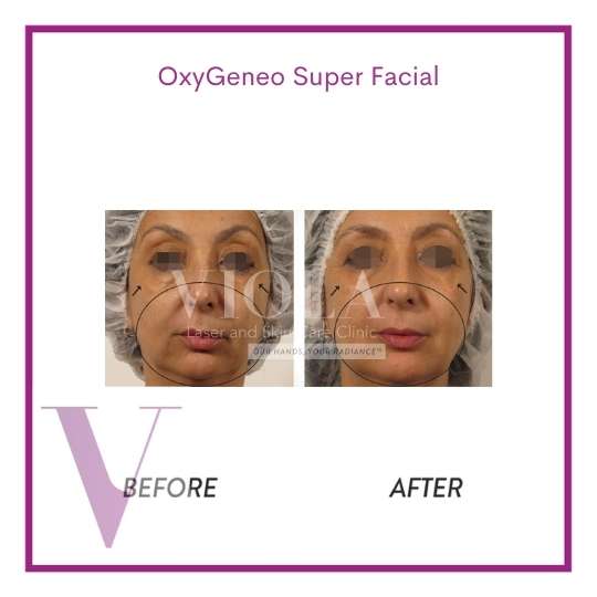 OxyGeneo Facial in Toronto - Viola Laser and Skin Care Clinic