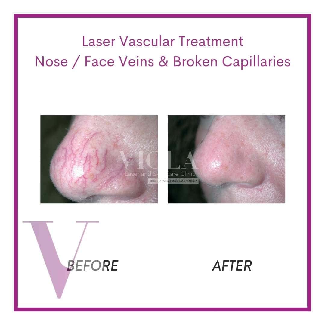Spider Vein Removal on Face and Legs - Laser Vein Treatment Toronto