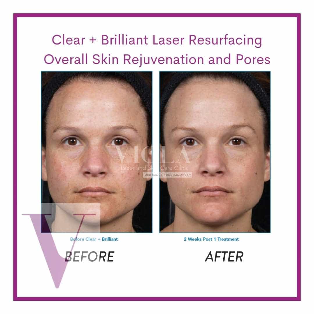 Before and After Gallery - Viola Laser and Skin Care Clinic