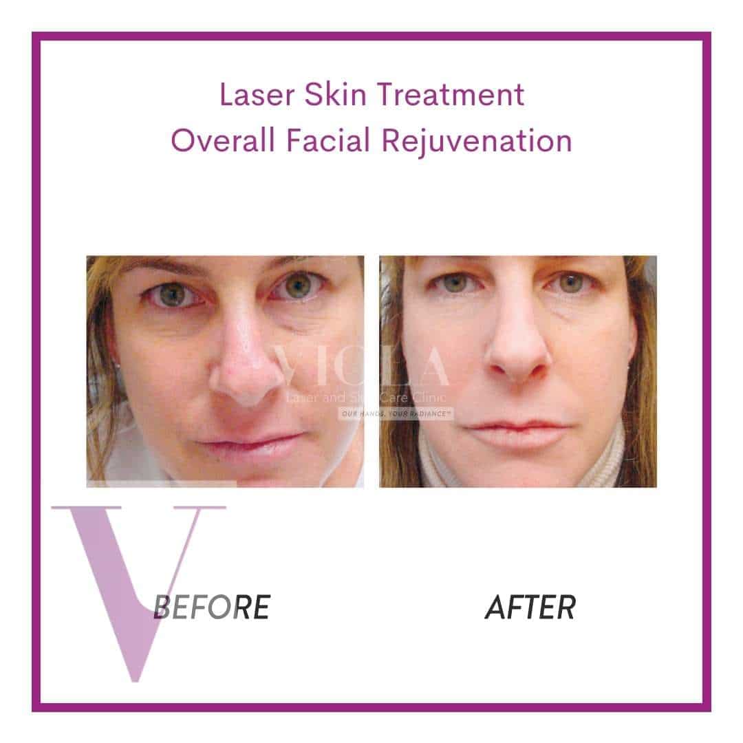 Alma Near Infrared (NIR) Skin Tightening - Viola Laser and Skin Care Clinic