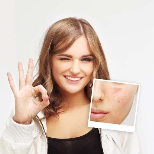 Laser Acne Treatment - Viola Laser and Skin Care Clinic