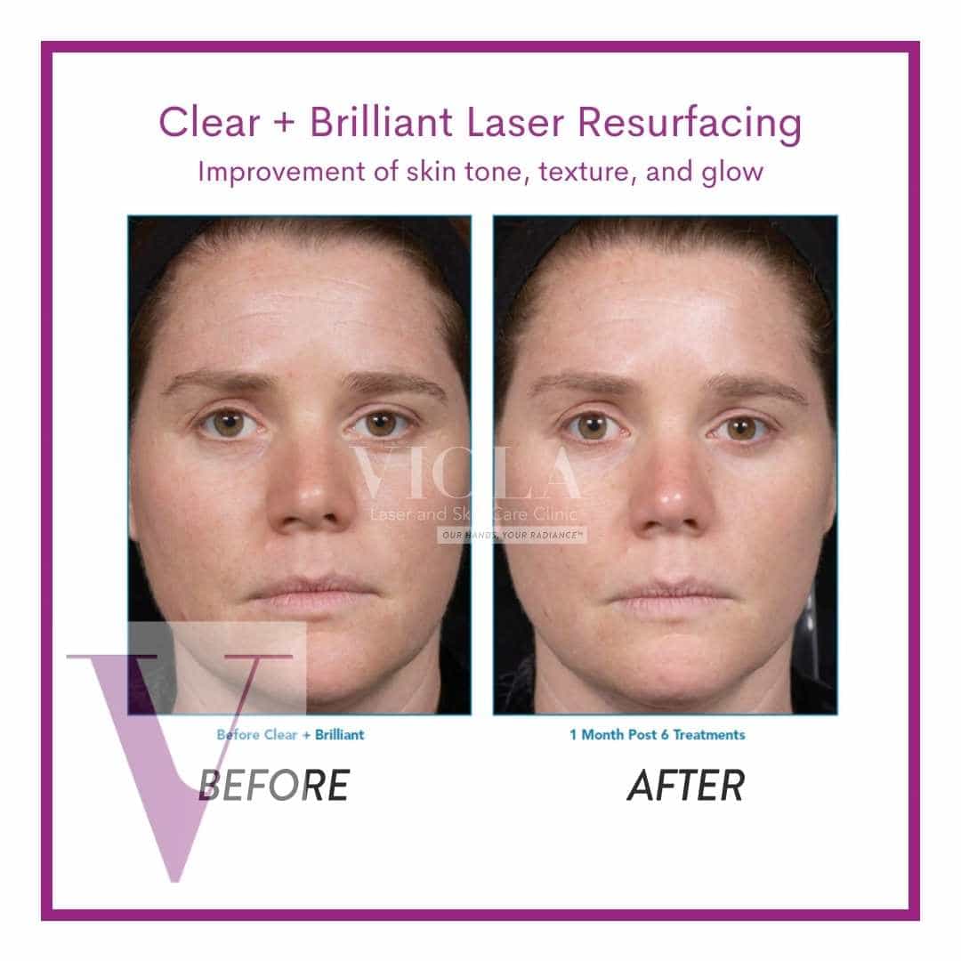 Clear and Brilliant Resurfacing Laser - Viola Laser and Skin Care Clinic