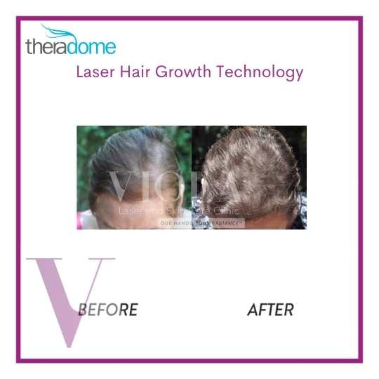 Theradome Laser Therapy for Hair Loss - Viola Laser and Skin Care Clinic