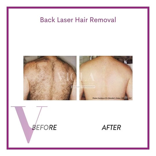 Laser Hair Removal Toronto - Viola Laser and Skin Care Clinic
