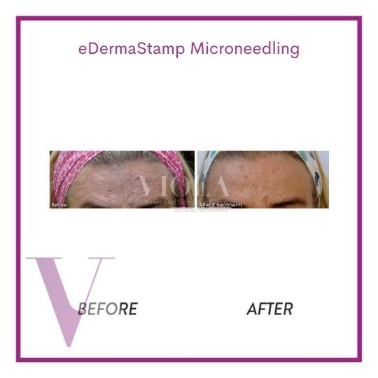 Microneedling Toronto - Viola Laser and Skin Care Clinic