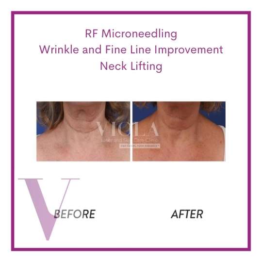 RF Microneedling in Toronto - Viola Laser and Skin Care Clinic