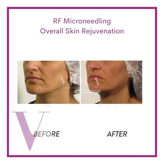 RF Microneedling in Toronto - Viola Laser and Skin Care Clinic