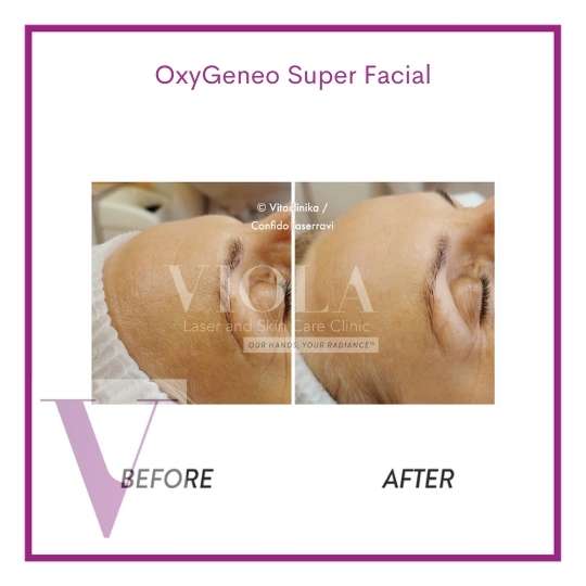 OxyGeneo Facial in Toronto - Viola Laser and Skin Care Clinic