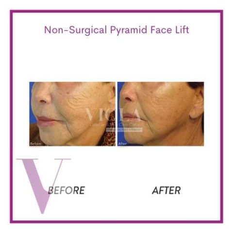 Non Surgical FaceLift Toronto - Viola Laser and Skin Care Clinic
