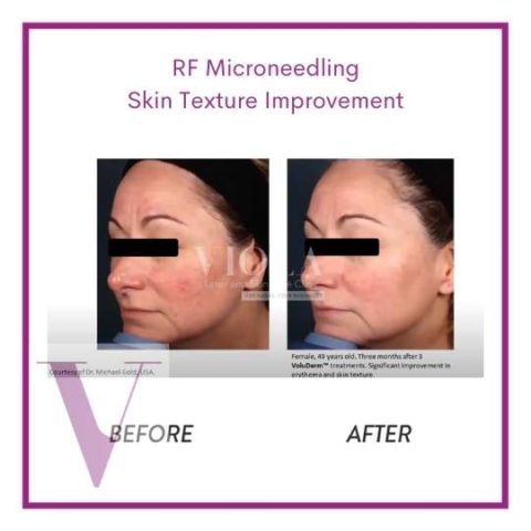 RF Microneedling in Toronto - Viola Laser and Skin Care Clinic