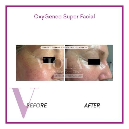 OxyGeneo Facial in Toronto - Viola Laser and Skin Care Clinic