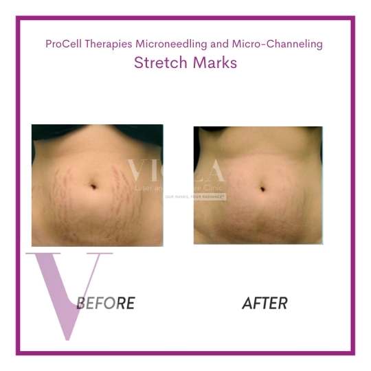 Microneedling Toronto - Viola Laser and Skin Care Clinic