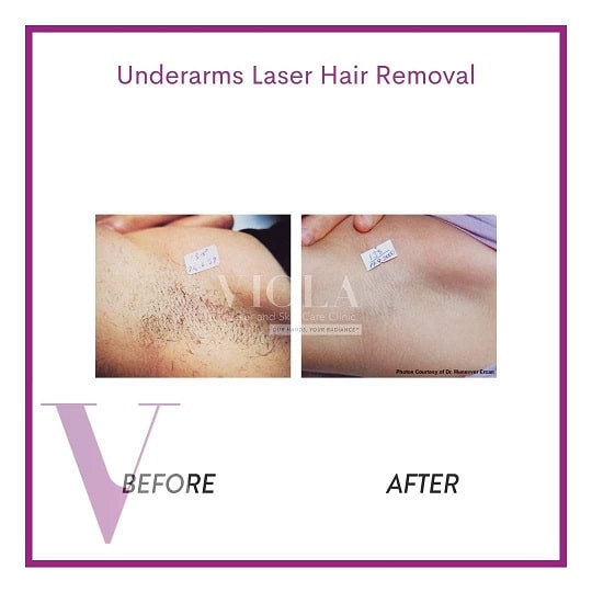 ProCell Therapies Micro-Channeling and Micro-Needling - Viola Laser and ...