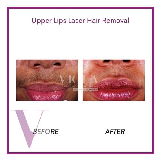 Laser Hair Removal Toronto - Viola Laser and Skin Care Clinic