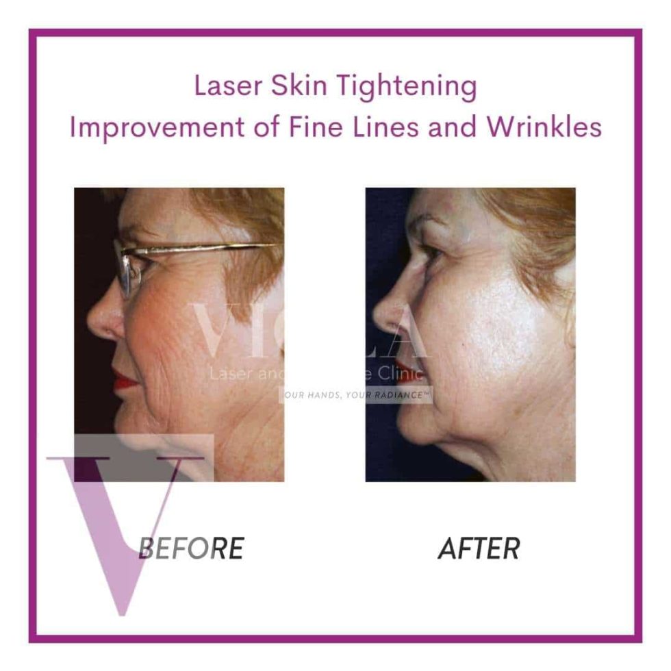Alma Near Infrared (NIR) Skin Tightening - Viola Laser and Skin Care Clinic