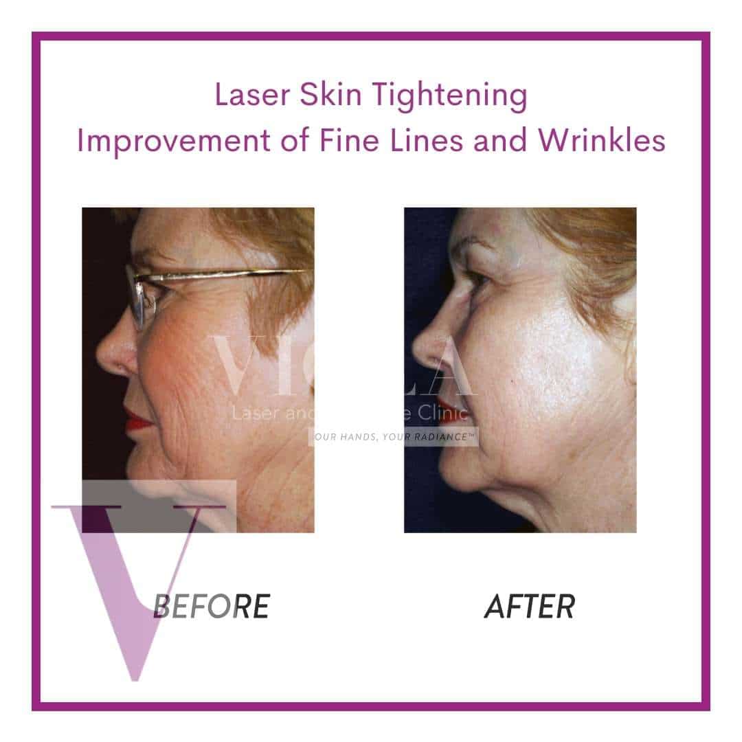 Alma Near Infrared (NIR) Skin Tightening - Viola Laser and Skin Care Clinic