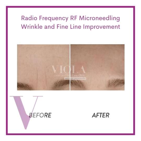 RF Microneedling in Toronto - Viola Laser and Skin Care Clinic